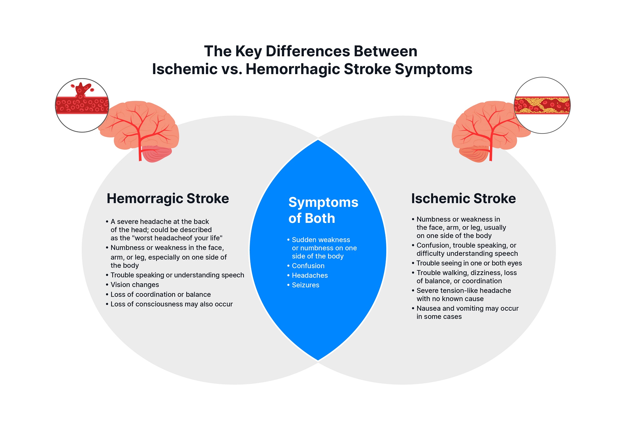Ischemic vs. Hemorrhagic Stroke Symptoms